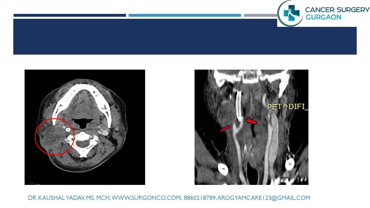 Swollen Neck Lymph Nodes Cancer Danger Than Origin Site Of Cancer